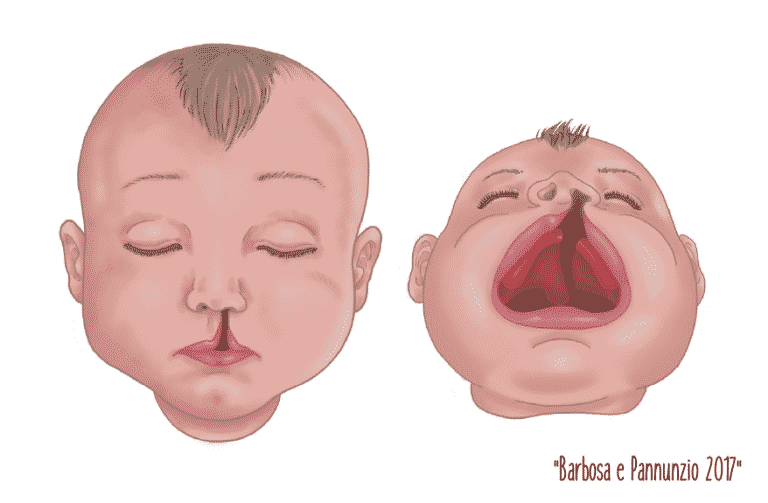 Como estimular a fala da criança com fissura labiopalatina? – Fofuuu 🧠🚀